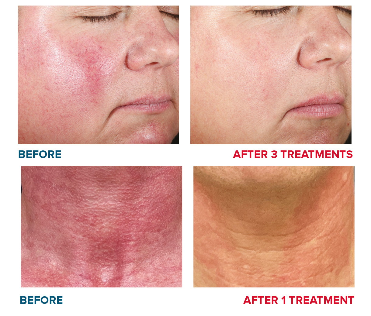 Derma V Láser de pulso largo Nd YAG y láser vascular KTP - Lutronic