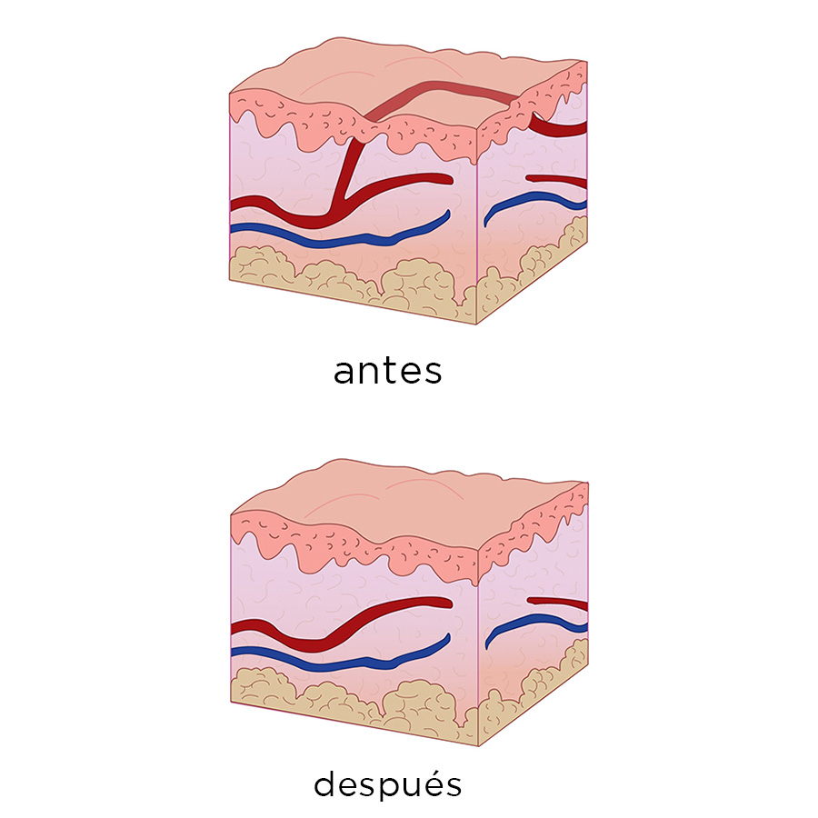 Derma V Láser de pulso largo Nd YAG y láser vascular KTP - Lutronic