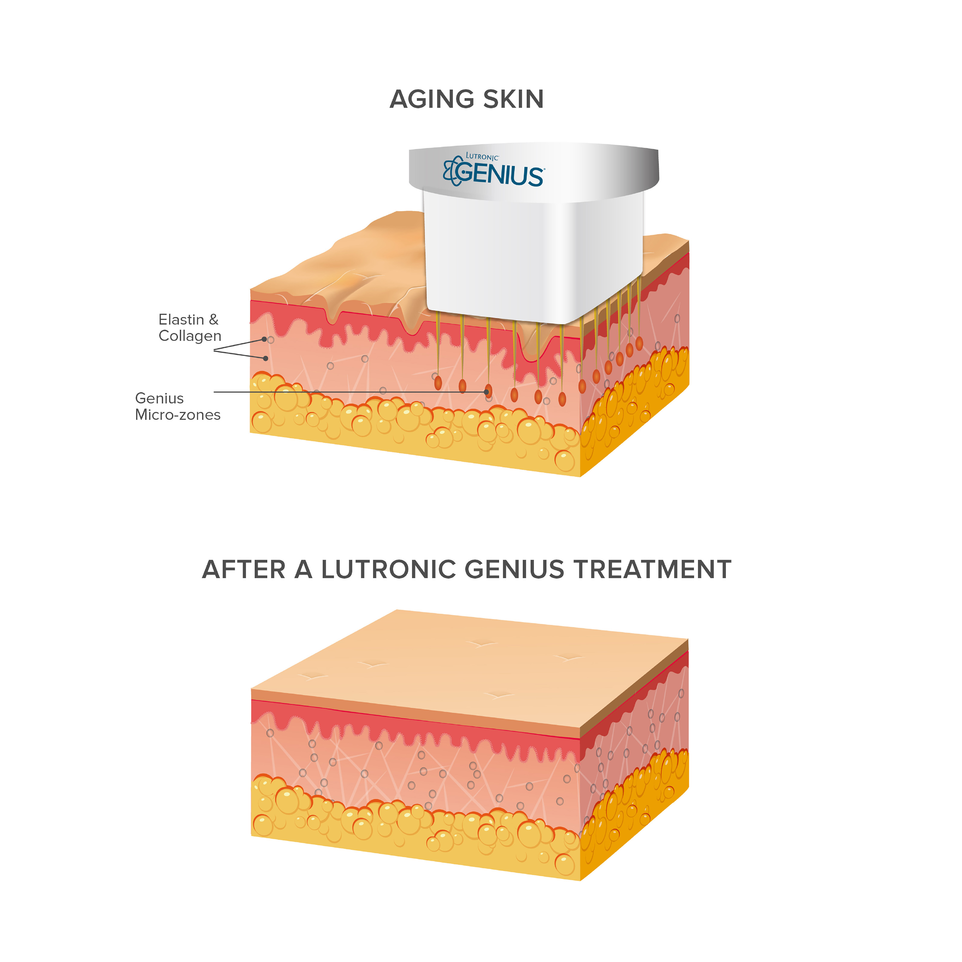 Genius radiofrcuencia con microagujas Lutronic